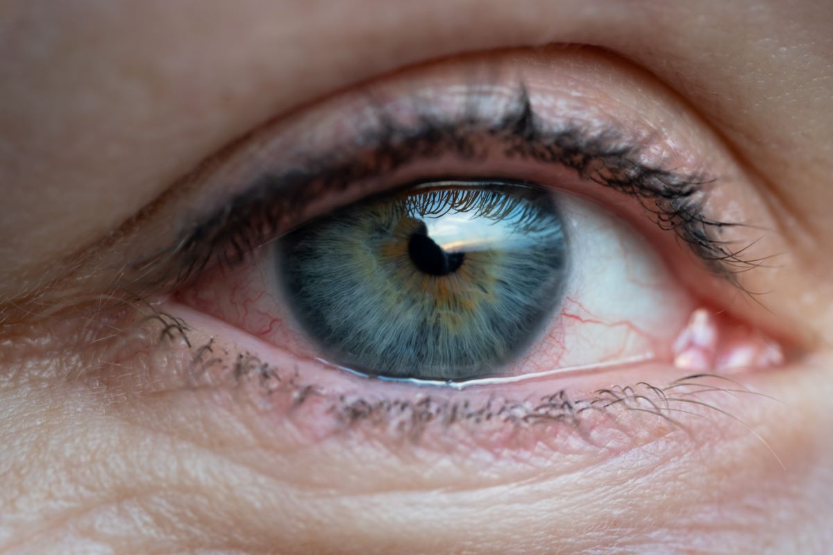 Les 10 infos sur les yeux rouges : causes, symptômes et remèdes